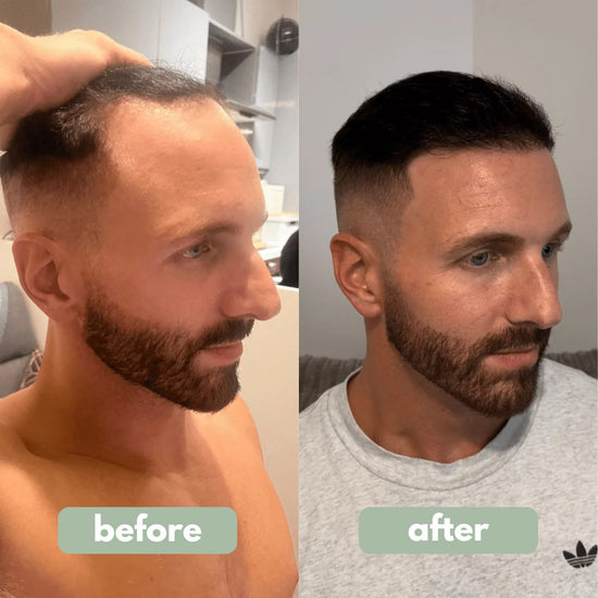 Reverse - Hair Growth Serum – Reverse Hair Co